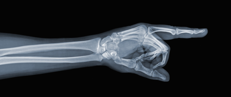Single Fraction Radiation for Bone Metastasis